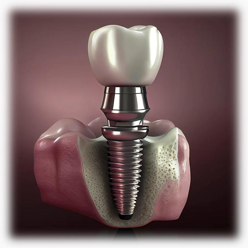 Implantodontia - Implante Dentário